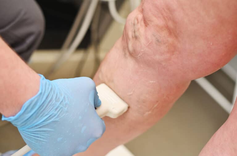 In Rooms VenaSeal Glue & Sclerotherapy - Dr Peter Hansen
